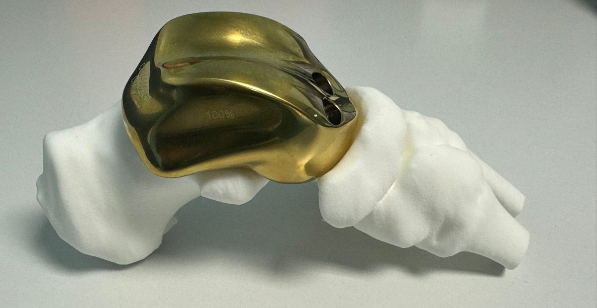 Al Policlinico di Abano impiantata una protesi d'astragalo in titanio ...